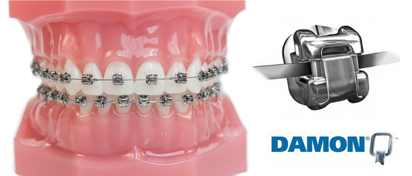Self-ligating braces Damon – OrtoDental